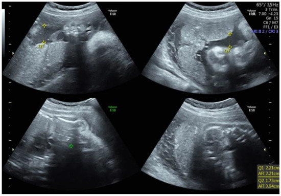 Polyhydramnios Ultrasound