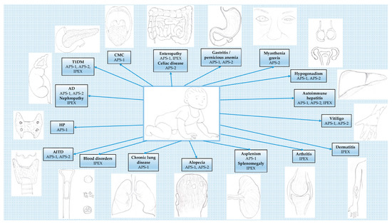 Autoimmune Polyendocrine Syndromes in the Pediatric Age