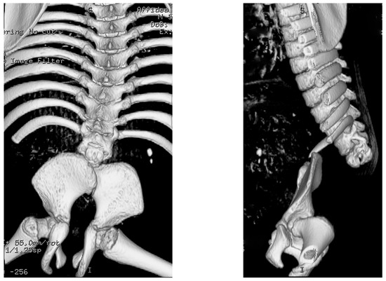 Caudal Regression Syndrome—A Narrative Review: An Orthopedic Point of View