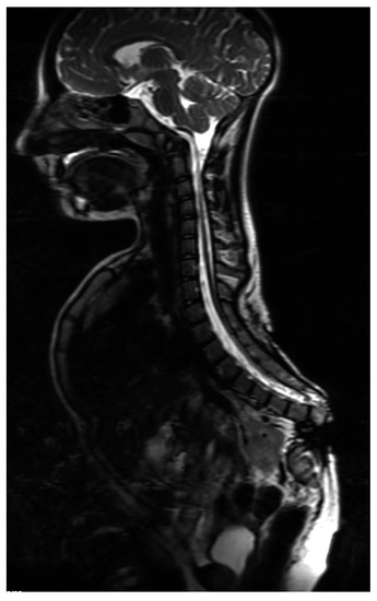 Caudal Regression Syndrome—A Narrative Review: An Orthopedic Point of View