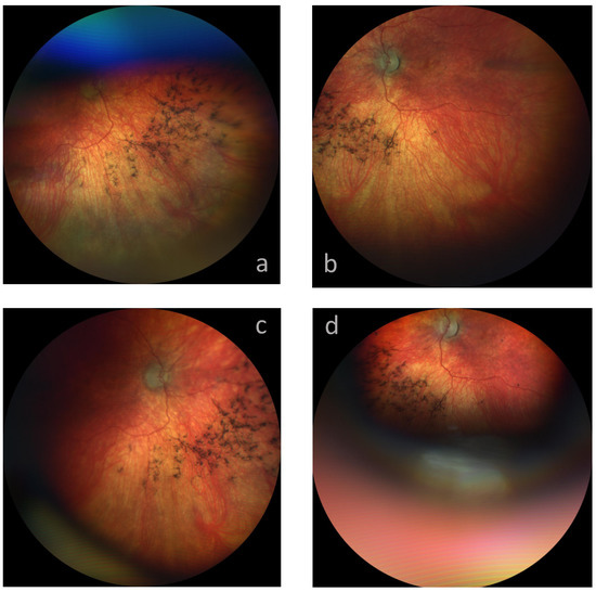 Multiple Sulfatase Deficiency from an Ophthalmologist’s Perspective ...