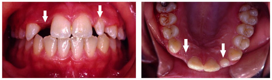 Permanent Tooth Agenesis and Associated Dental Anomalies among ...