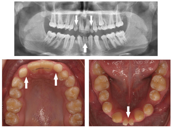 Permanent Tooth Agenesis and Associated Dental Anomalies among ...