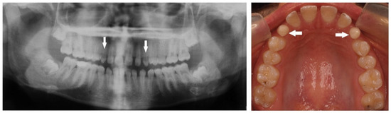 Permanent Tooth Agenesis and Associated Dental Anomalies among ...