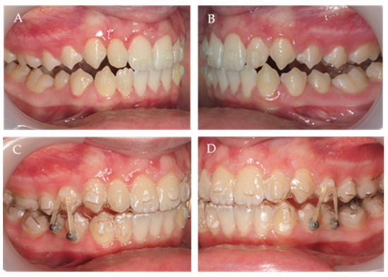 Scissor Bite in Growing Patients: Case Report Treated with Clear Aligners