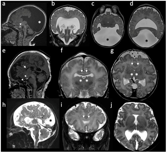 Holoprosencephaly: Review of Embryology, Clinical Phenotypes, Etiology ...