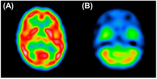 Evaluating Dysfunction in Fever-Induced Paroxysmal Weakness and ...