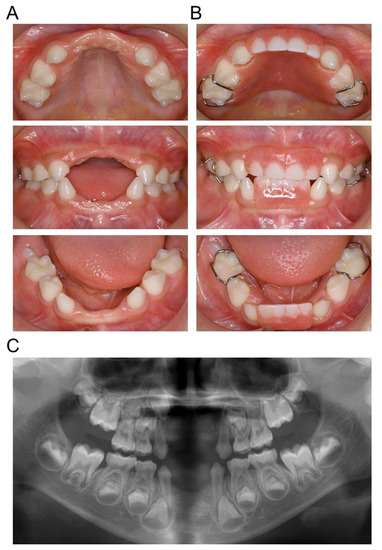 Five-Year Follow-Up of a Child with Non-Syndromic Oligodontia from before the Primary Dentition ...