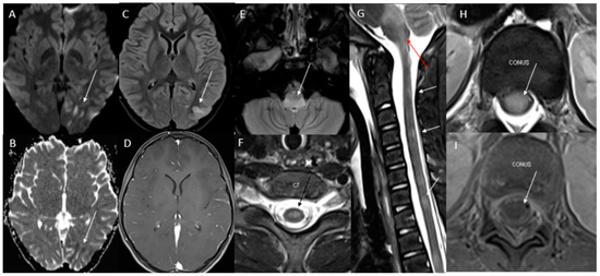 Elsberg Syndrome with Mixed Presentation as Meningitis Retention ...