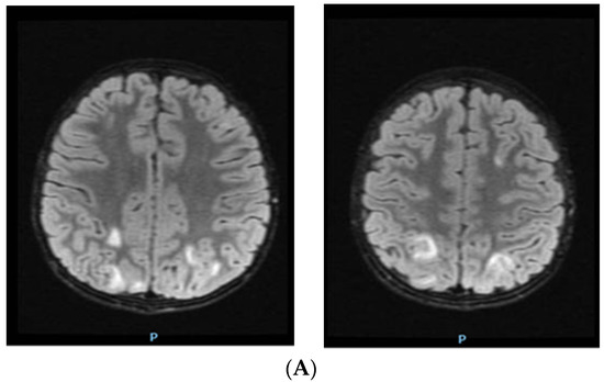 Posterior Reversible Encephalopathy Syndrome in a Pediatric Patient ...