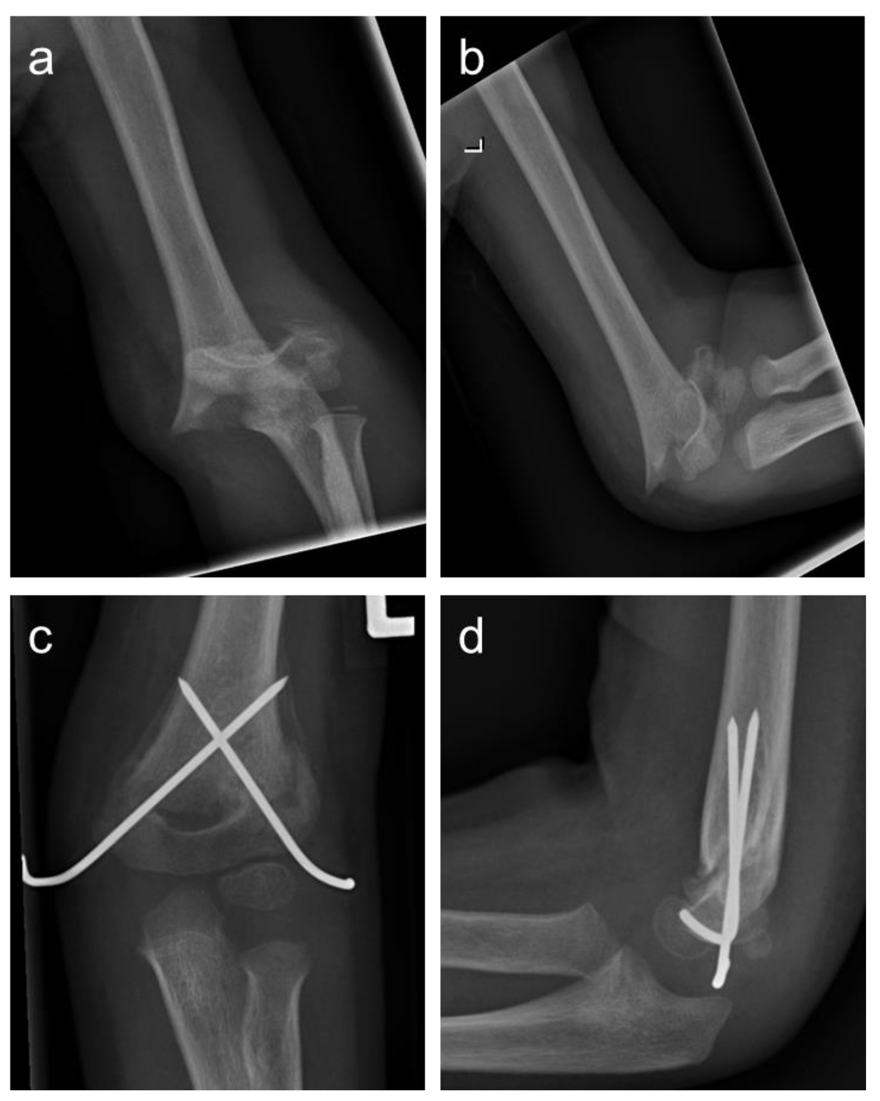 Supracondylar Humerus Fracture