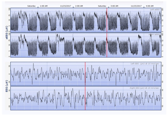 The Role of Amplitude-Integrated Electroencephalography (aEEG) in ...