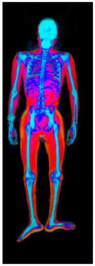Targeting Sarcopenia as an Objective Clinical Outcome in the Care of ...