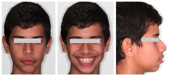 Bimaxillary Dentoalveolar Protrusion Case Treated with Anchorage by ...