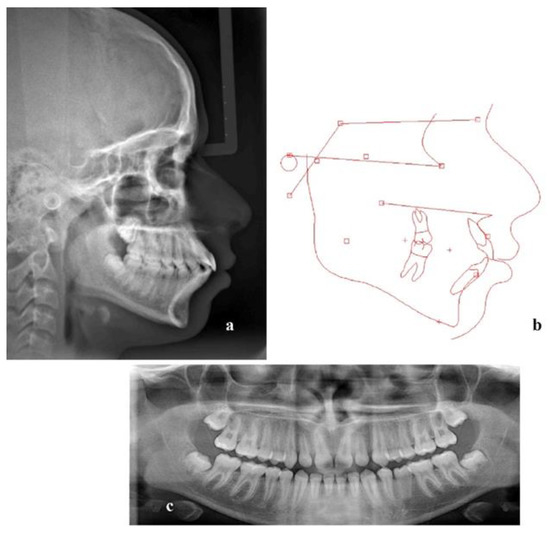 Bimaxillary Dentoalveolar Protrusion Case Treated with Anchorage by ...
