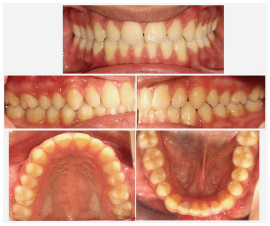 Bimaxillary Dentoalveolar Protrusion Case Treated with Anchorage by ...