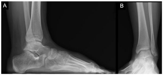 Children | Free Full-Text | Juvenile Osteochondral Lesions of the Talus ...