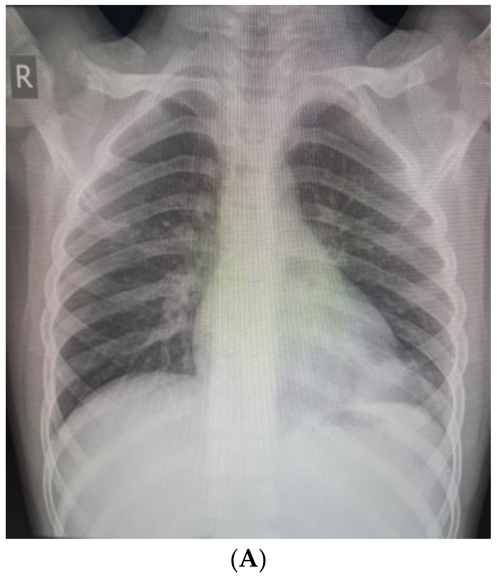 Children | Free Full-Text | Surgical Treatment of Lung Abscess Due to an Awn Aspiration in a 9 ...