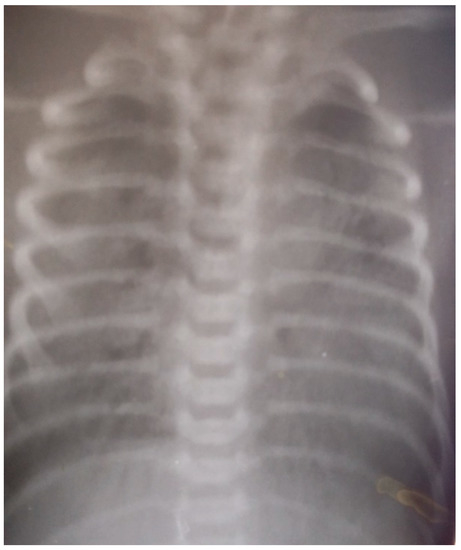 Interstitial Lung Disease in Neonates: A Long Road Is Being Paved