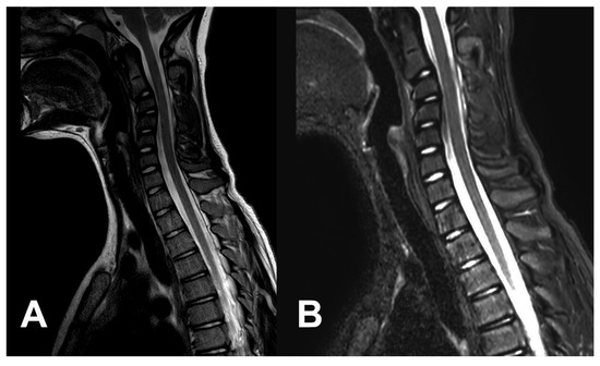 Acute Progressive Pediatric Post-Traumatic Kyphotic Deformity