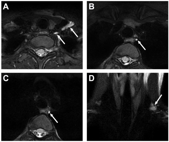 Pictorial Review of MRI Findings in Acute Neck Infections in Children
