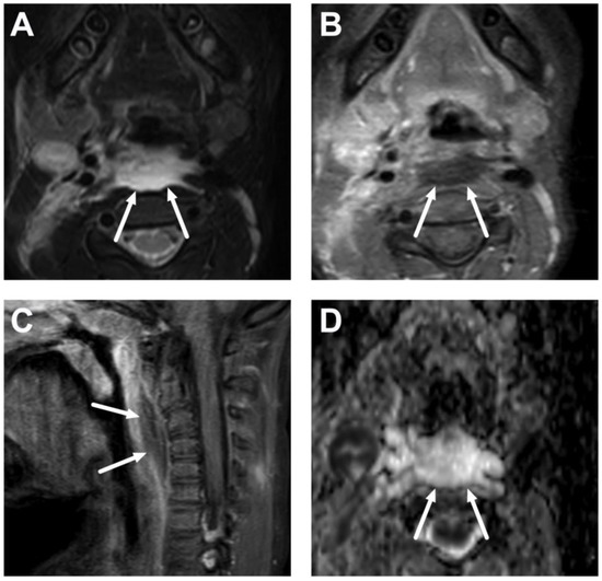 Pictorial Review of MRI Findings in Acute Neck Infections in Children