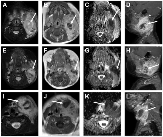 Pictorial Review of MRI Findings in Acute Neck Infections in Children