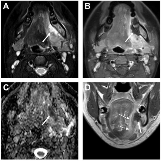 Pictorial Review of MRI Findings in Acute Neck Infections in Children