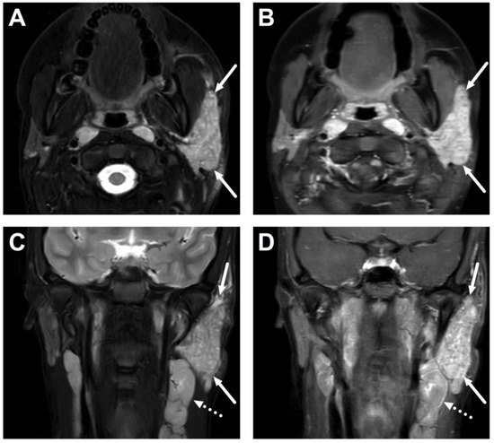 Pictorial Review of MRI Findings in Acute Neck Infections in Children