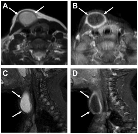 Pictorial Review of MRI Findings in Acute Neck Infections in Children