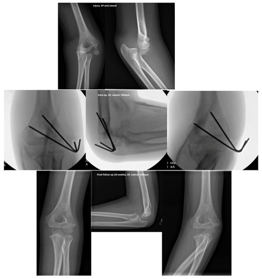Pediatric Elbow Dislocations and Associated Fractures