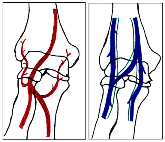 Lateral Humeral Condyle Fractures in Pediatric Patients