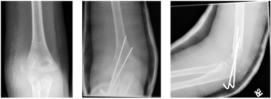 Lateral Humeral Condyle Fractures in Pediatric Patients