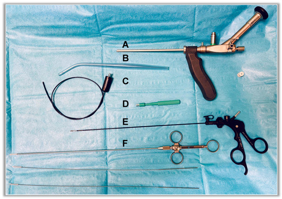 Endoscopic Pilonidal Sinus Treatment: Preliminary Results, Learning ...