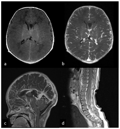 A New Pattern of Brain and Cord Gadolinium Enhancement in Molybdenum ...
