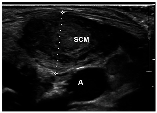 Efficacy of Intensive Inpatient Therapy in Infants with Congenital ...