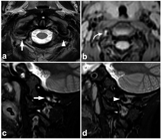 Emergency MRI in Spine Trauma of Children and Adolescents—A Pictorial ...