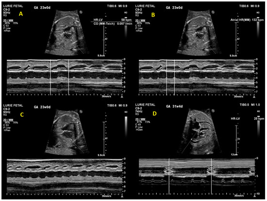 Fetal Congenital Complete Heart Block: A Rare Case with an Extremely ...