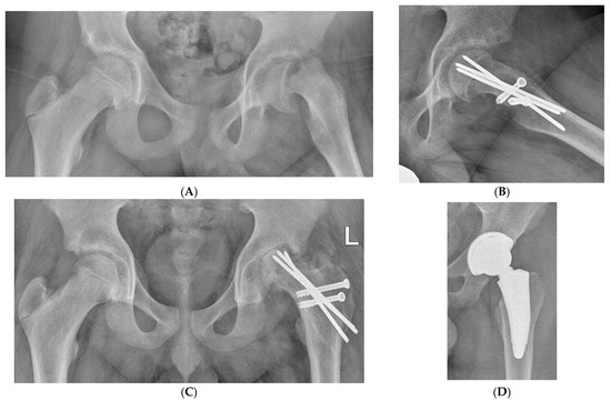 Children | Free Full-Text | Changing Treatment Philosophy of Slipped ...