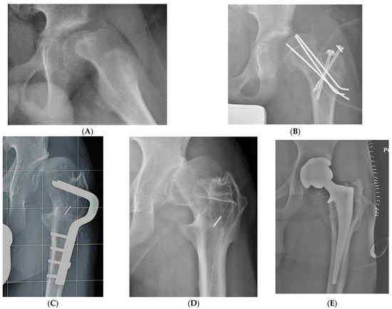 Children | Free Full-Text | Changing Treatment Philosophy of Slipped ...