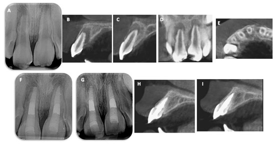 External Inflammatory Root Resorption in Traumatized Immature Incisors ...