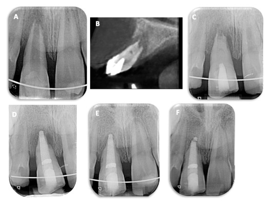 External Inflammatory Root Resorption in Traumatized Immature Incisors ...