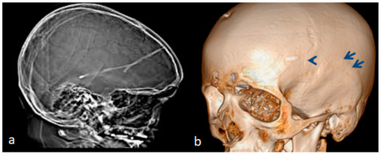 Meticulous and Early Understanding of Congenital Cranial Defects Can ...