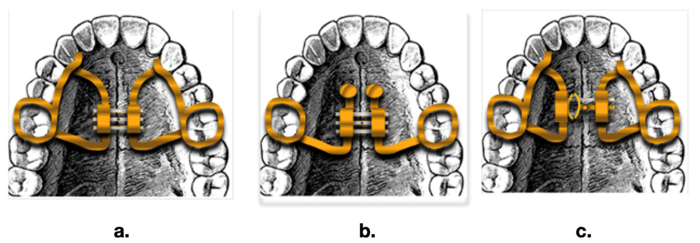 Comparison of Different Types of Palatal Expanders: Scoping Review