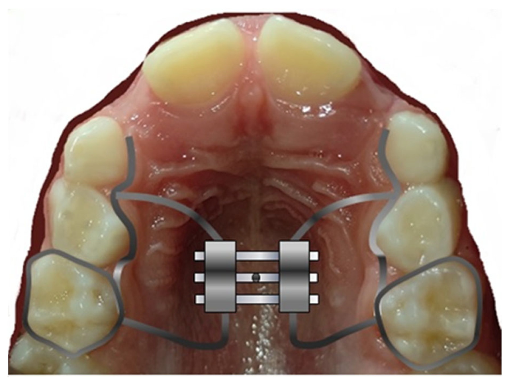 Comparison of Different Types of Palatal Expanders: Scoping Review
