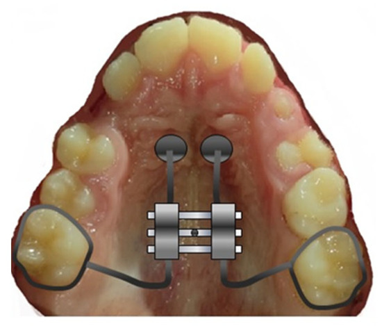 Comparison of Different Types of Palatal Expanders: Scoping Review