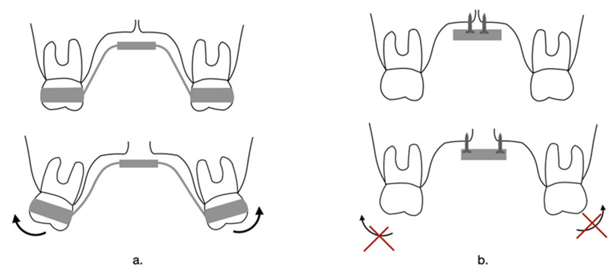 Comparison of Different Types of Palatal Expanders: Scoping Review