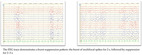 Genotype–Phenotype Analysis of Children with Epilepsy Referred for ...