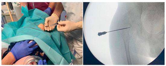 Study Confirms Safety and Effectiveness of Intra-Articular Glucocorticoids for Painful Hip ...