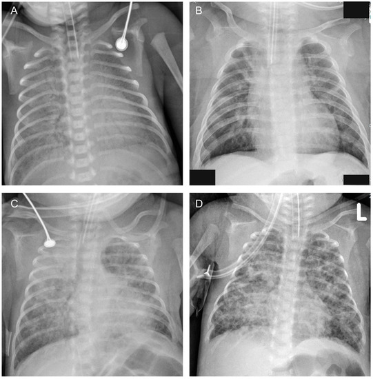 The Most Valuable Predictive Factors for Bronchopulmonary Dysplasia in ...